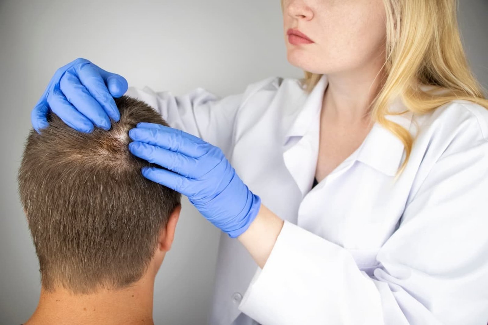 HAIR LOSS TYPES: ALOPECIA AREATA DIAGNOSIS AND TREATMENT
